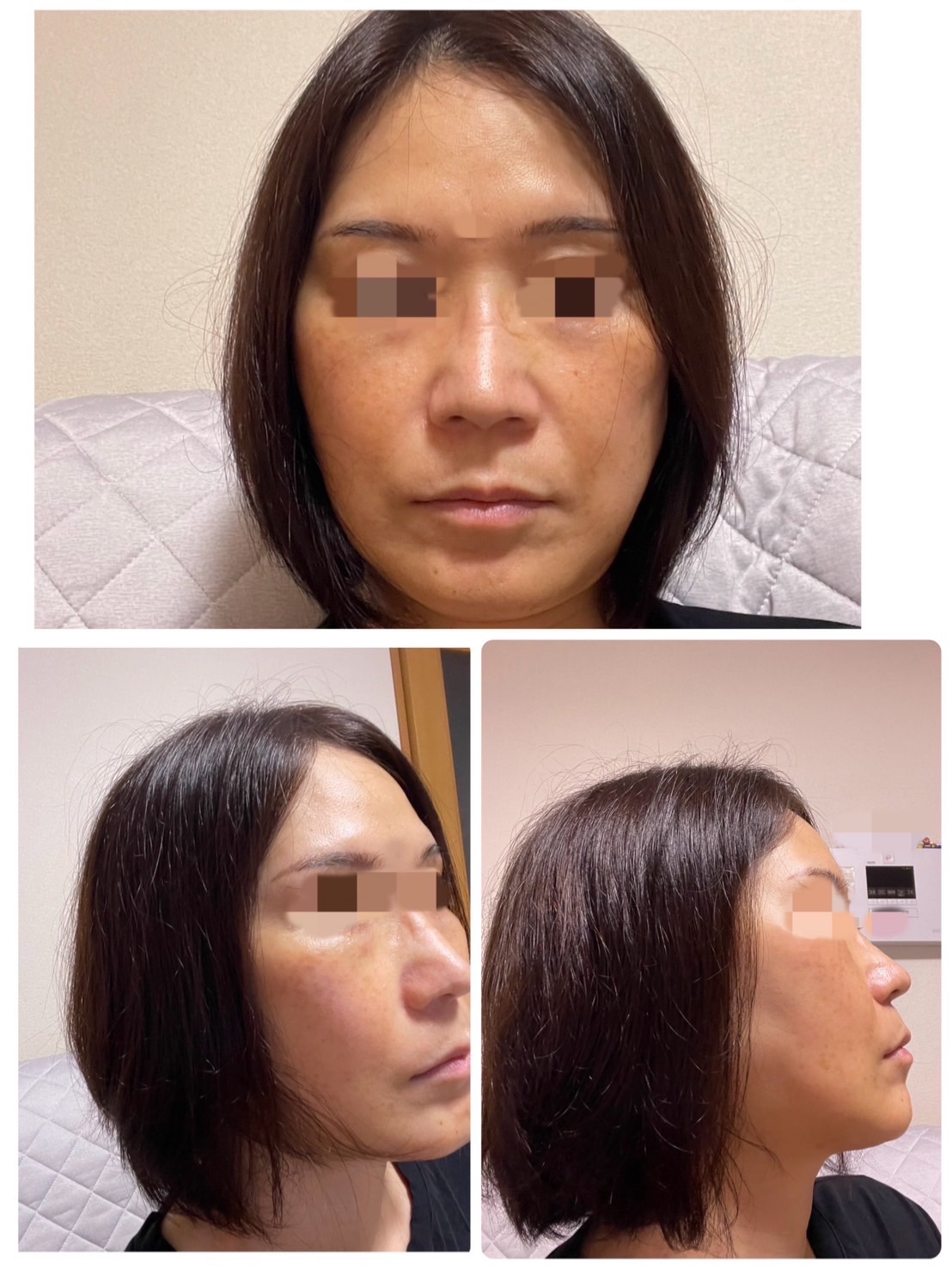 의사에게 물어보세요 왼쪽 2주차 오른쪽 강남언니 1등 성형수술and피부시술 정보앱
