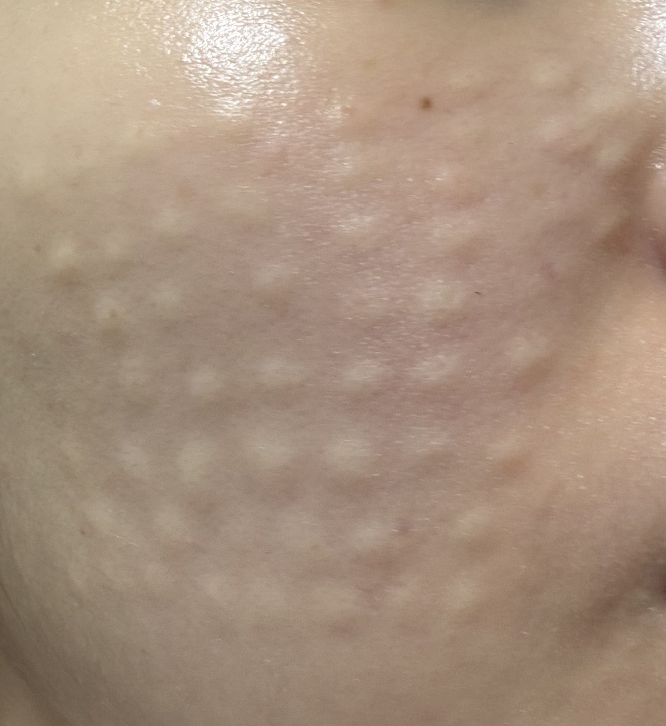 의사에게 물어보세요: 스킨보톡스 2cc ... | 강남언니 - 1등 성형수술&피부시술 정보앱