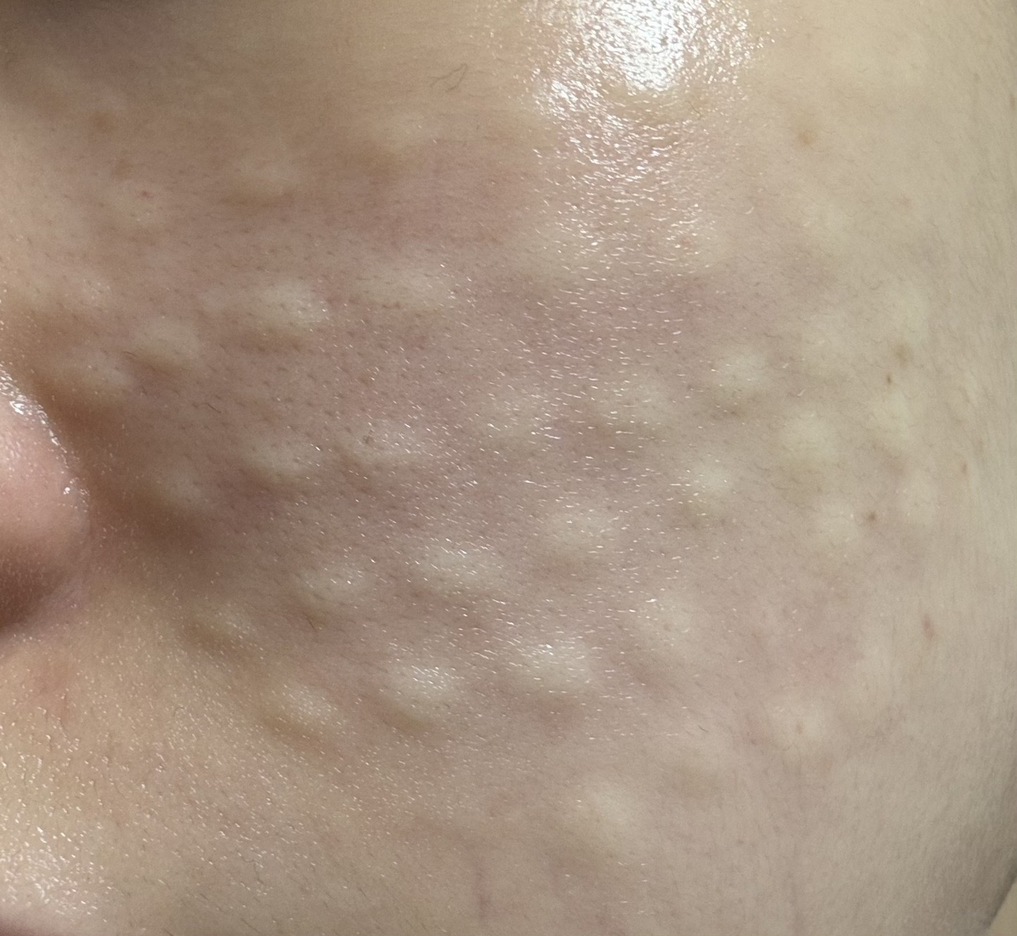 의사에게 물어보세요: 스킨보톡스 2cc ... | 강남언니 - 1등 성형수술&피부시술 정보앱