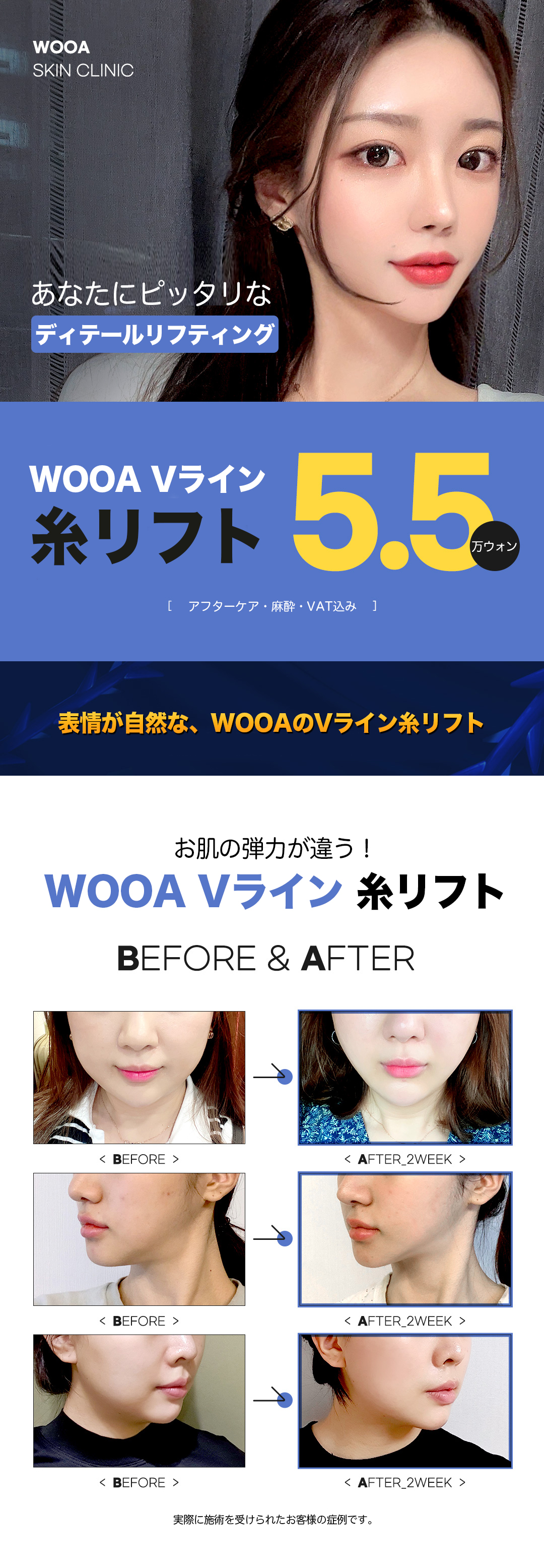 WOOA Vライン糸リフト by ウア美容外科医院 | カンナムオンニ-美容医療・整形のすべて