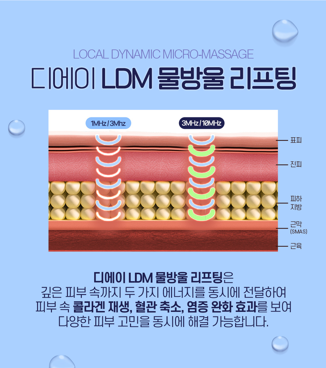 디에이 LDM 물방울리프팅 | 디에이성형외과의원