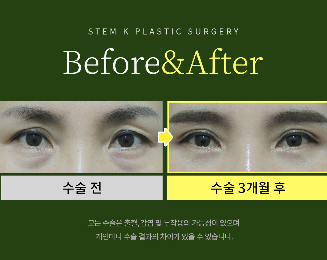 리메이크 매몰 눈재수술 By 스템케이성형외과의원 강남언니 1등 성형수술and피부시술 정보앱