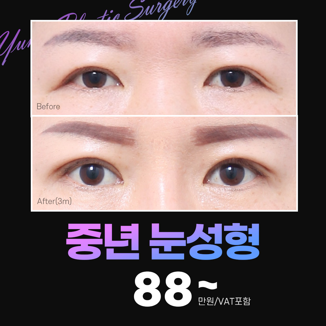유노 중년 눈성형 유노성형외과