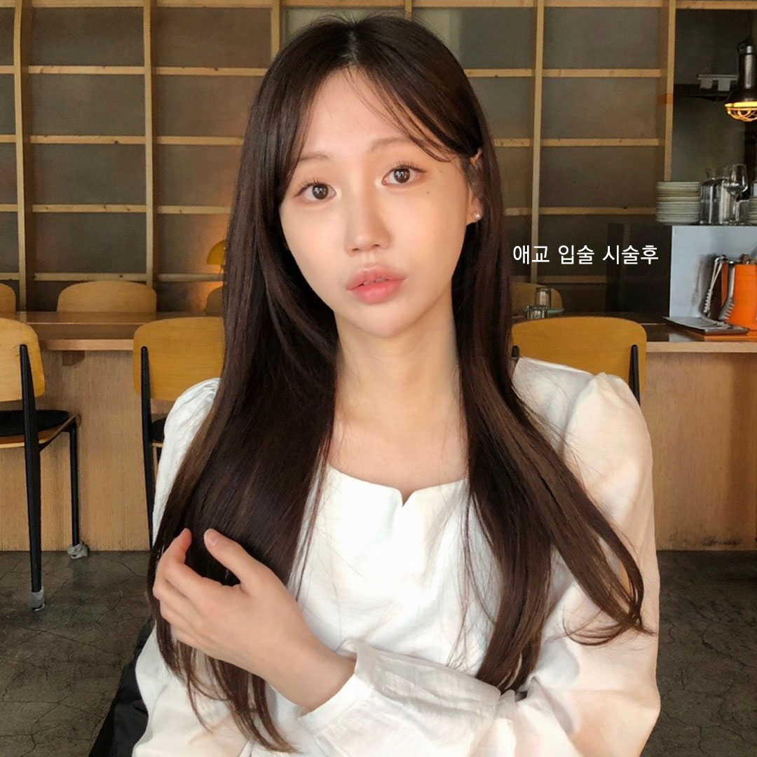 자유수다: 애교필러랑 입술필러... | 강남언니 - 1등 성형수술&피부시술 정보앱