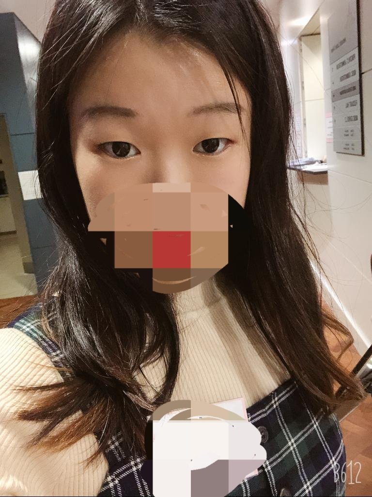 자유수다 쌍커풀 눈매교정 강남언니 1등 성형수술and피부시술 정보앱