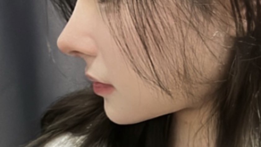 시술 수술 질문 오른쪽 같은 볼 강남언니 1등 성형수술and피부시술 정보앱