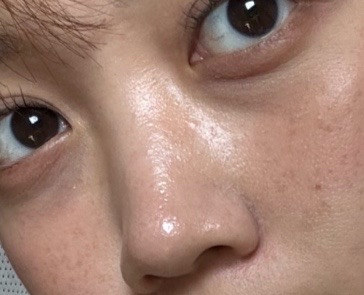 시술/수술 질문: 코수술 두 곳 고민... | 강남언니 - 1등 성형수술&피부시술 정보앱