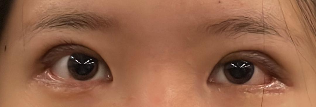 의사에게 물어보세요 안녕하세요 눈재수술 강남언니 1등 성형수술and피부시술 정보앱