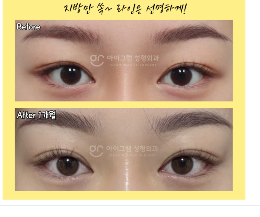 자유수다: 재재수술인데 이런 ... | 강남언니 - 1등 성형수술&피부시술 정보앱