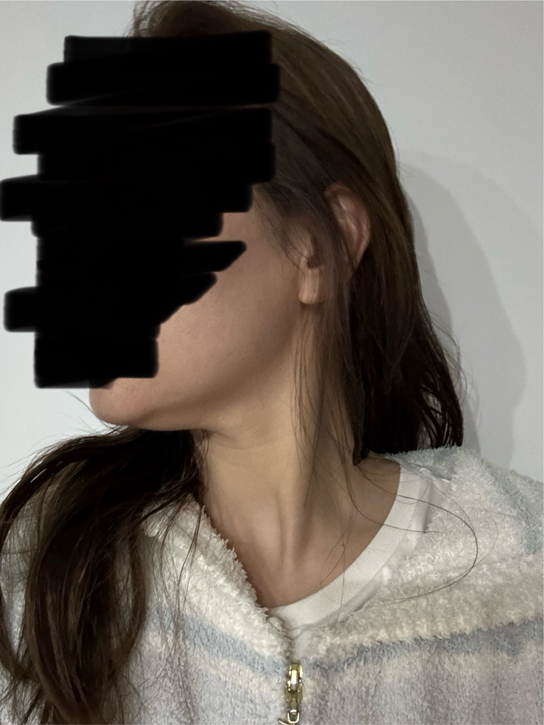 【効果重視の方へ】脂肪溶解注射｜FatX Core （顔）／ FatX Silueta（身体） | ウェルネスビューティークリニック 名古屋院